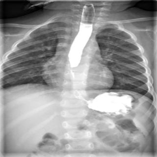 Rx Esofago con contrasto (Bario) | Clinical Medical Consulting